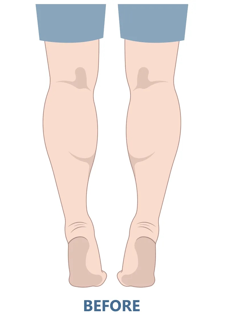 Calf Reduction Cosmetic Surgery Clinic | Signature Clinic